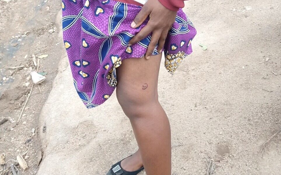 Strange disease that leaves 'numbers' on people's skin worries Mubende ...